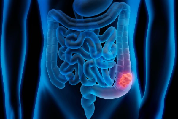 What Is The Difference Between Anal Cancer And Colon Cancer Roswell
